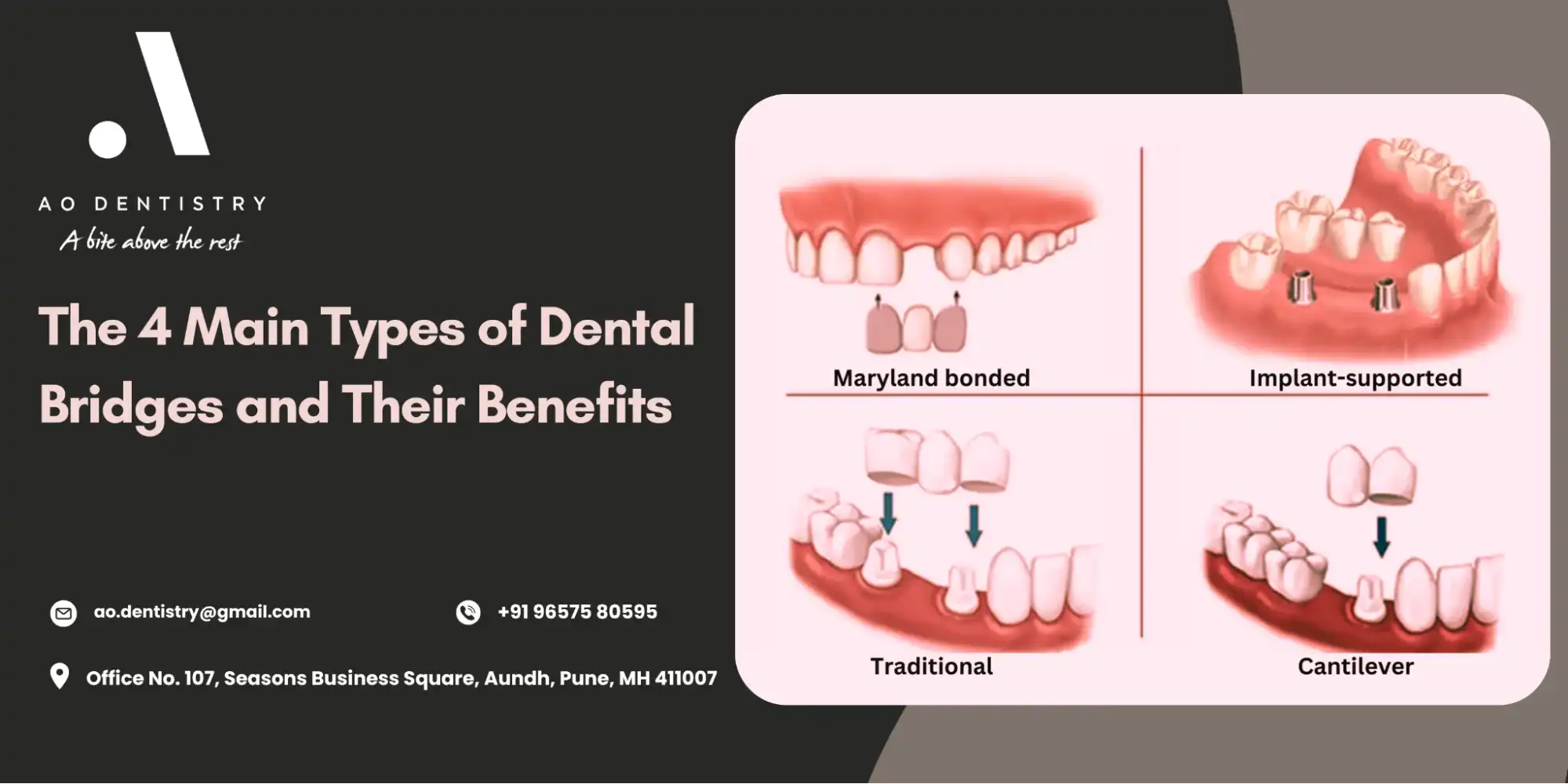 The 4 Main Types of Dental Bridges and Their Benefits | AO Dentistry