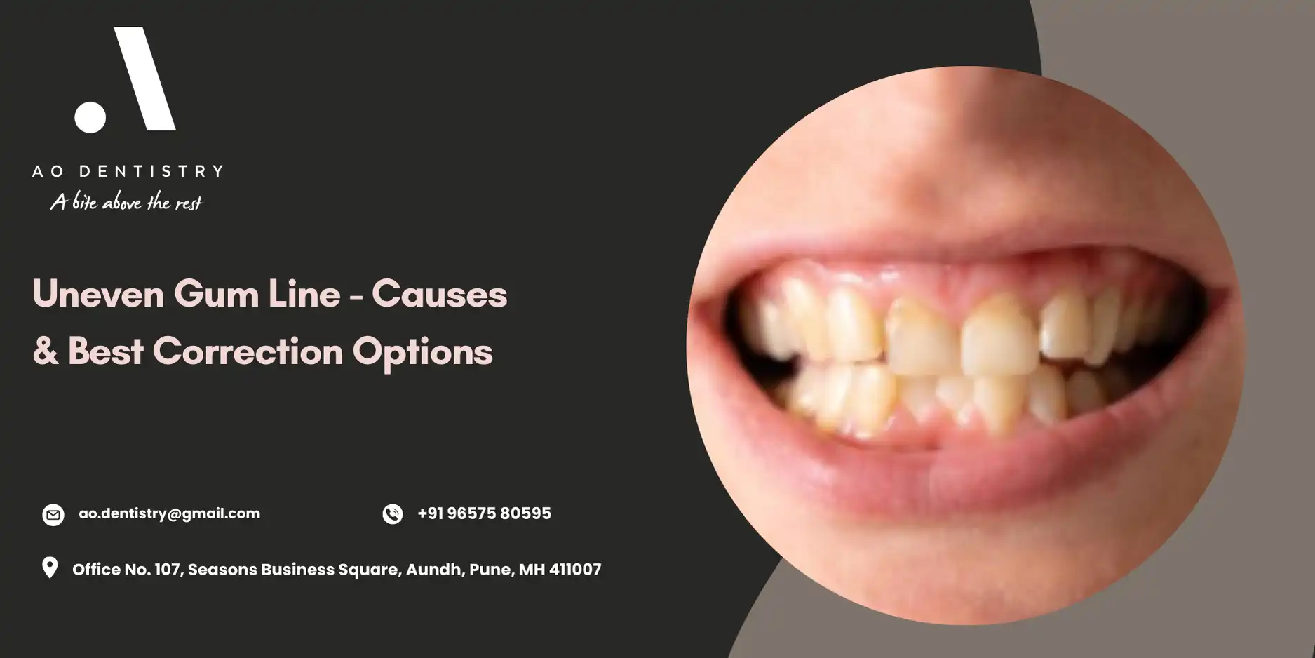 Uneven Gum Line - Causes & Best Correction Options | AO Dentistry