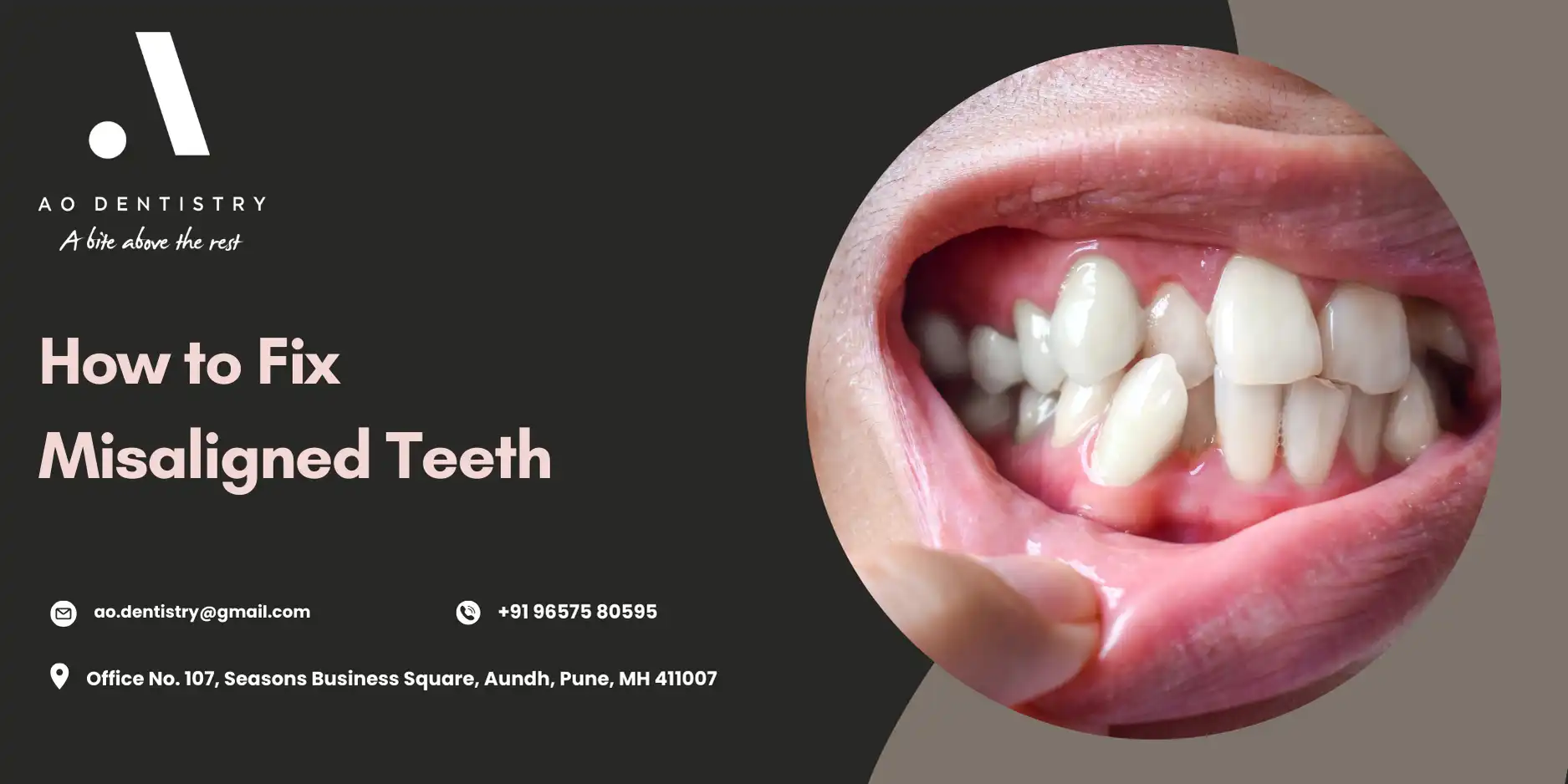 How to Fix Misaligned Teeth | Malocclusion of Teeth | AO Dentistry