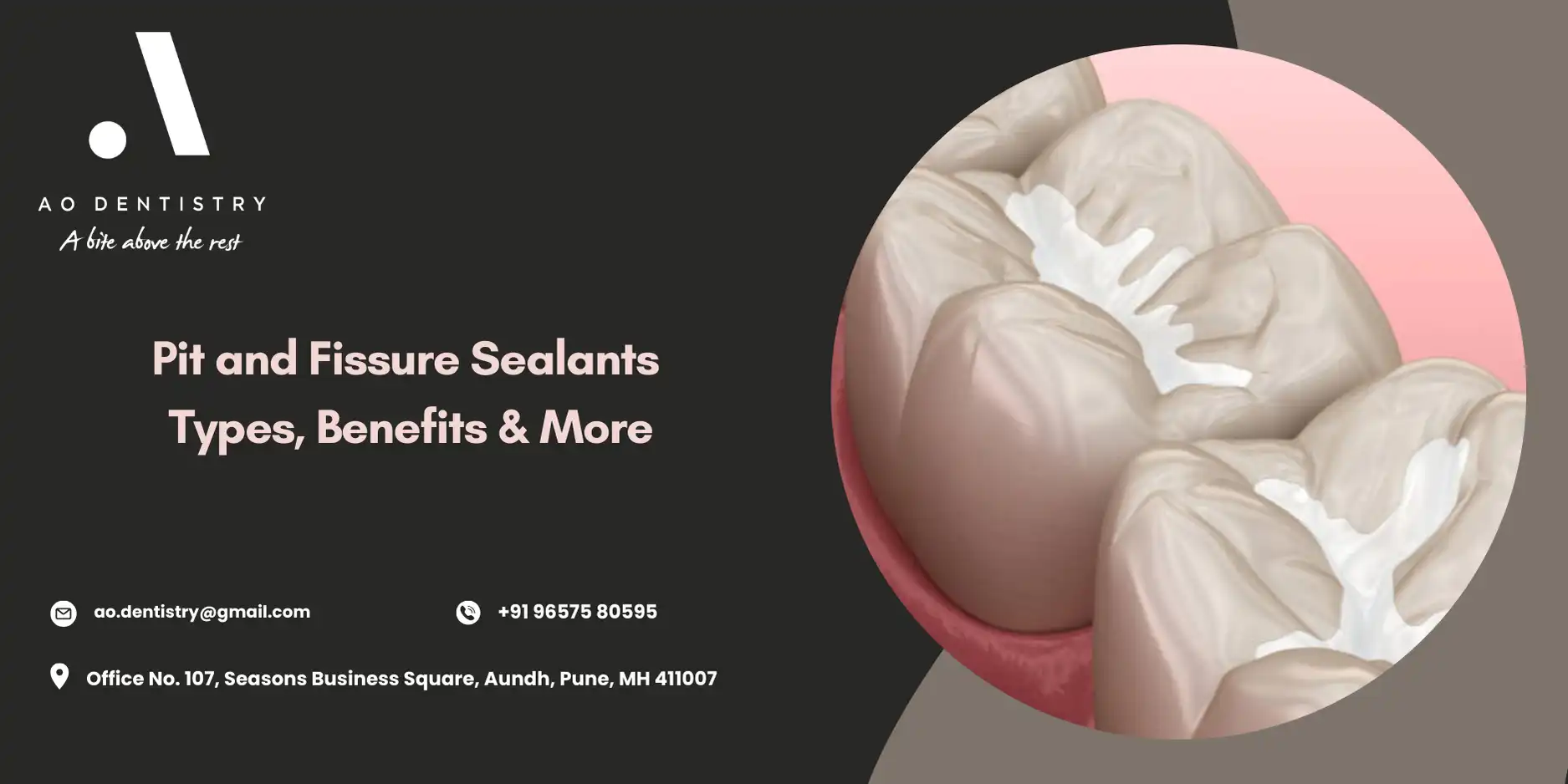 Pit and Fissure Sealants - Types, Benefits & More | AO Dentistry
