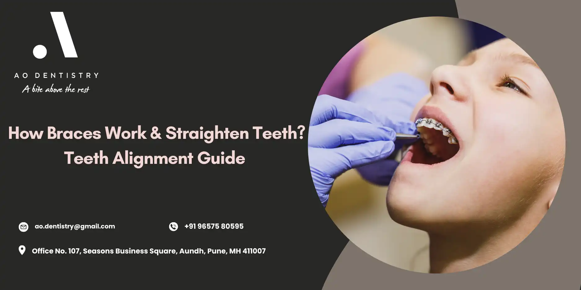 How Braces Work & Straighten Teeth – Teeth Alignment Guide | AO Dentistry